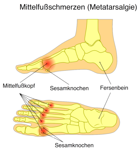 Fußgelenkschmerzen Spreizfuß | Arzt Lüneburg